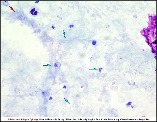 Plasmodium ovale - CELL - Atlas of Haematological Cytology
