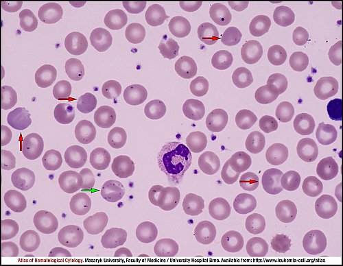 Pyruvate kinase deficiency - CELL - Atlas of Haematological Cytology