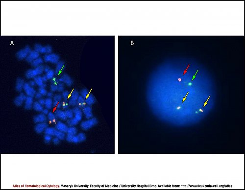 Acute promyelocytic leukaemia with ''PML-RARA'' - CELL - Atlas of ...