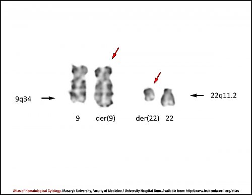 B-lymphoblastic leukaemia/lymphoma with t(9;22)(q34.1;q11.2); ''BCR ...