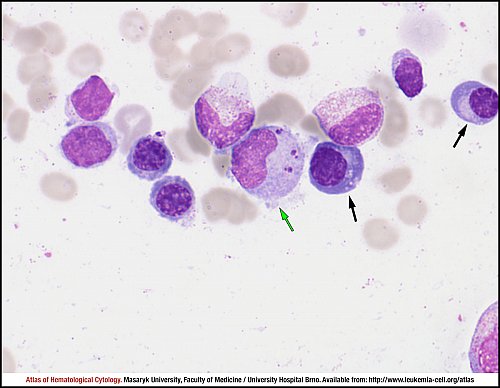 Visceral leishmaniasis - CELL - Atlas of Haematological Cytology
