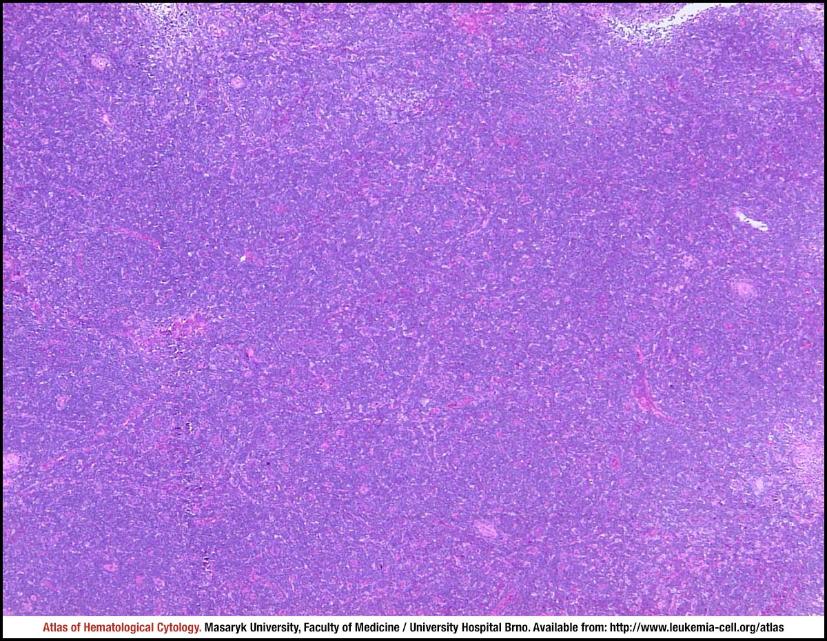 T-lymphoblastic leukaemia/lymphoma - CELL - Atlas of Haematological ...