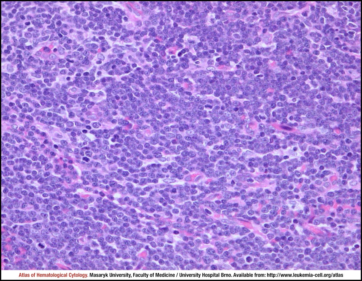 T-lymphoblastic leukaemia/lymphoma - CELL - Atlas of Haematological ...