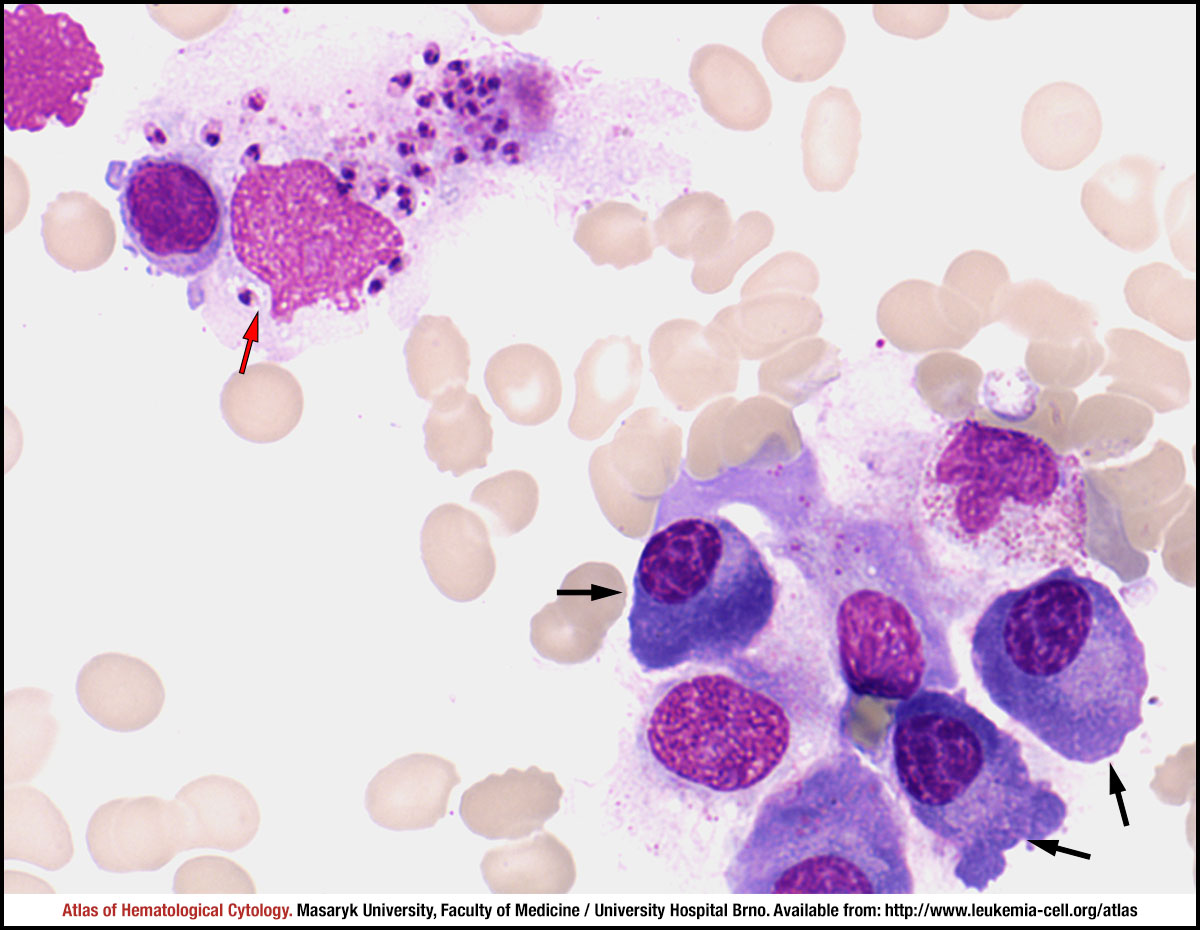 Visceral leishmaniasis - CELL - Atlas of Haematological Cytology