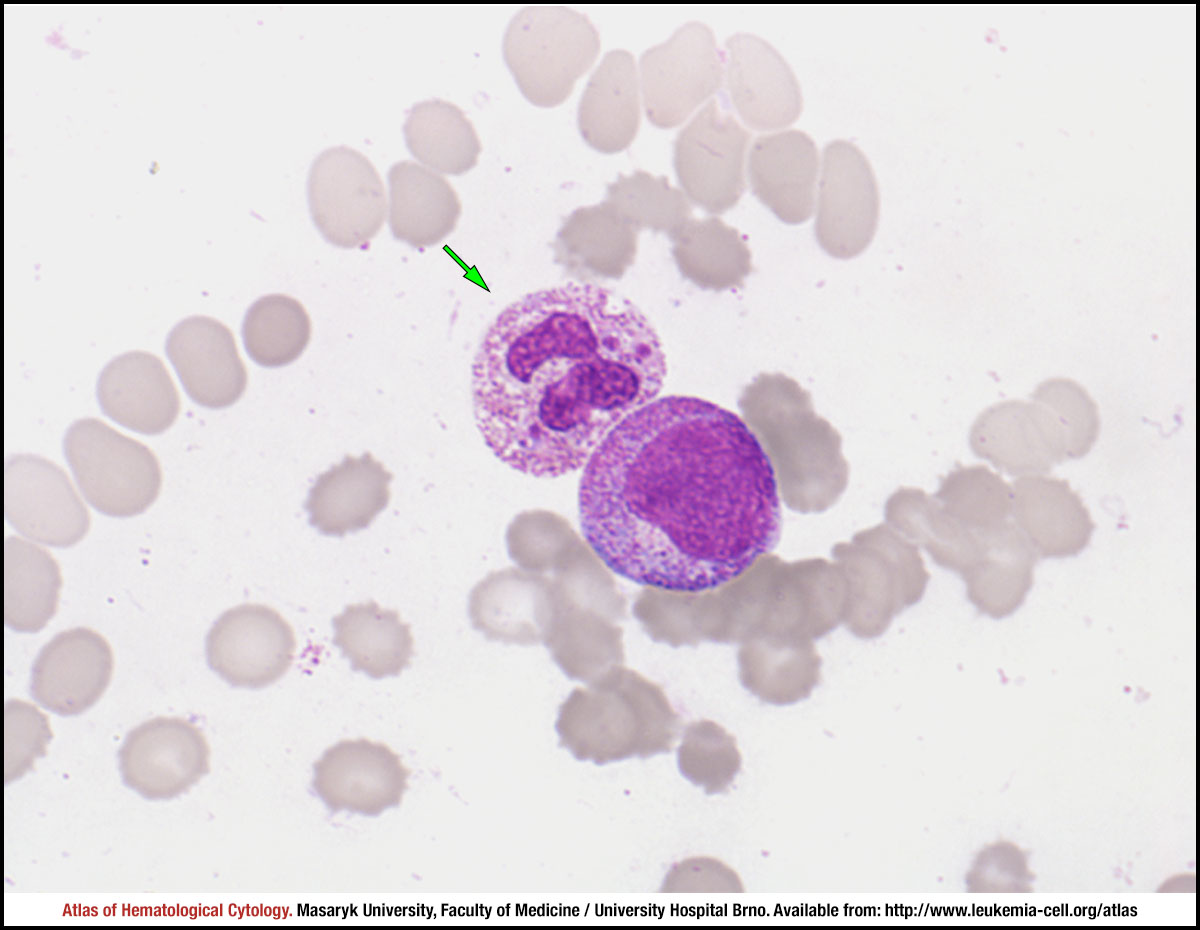 Visceral leishmaniasis - CELL - Atlas of Haematological Cytology