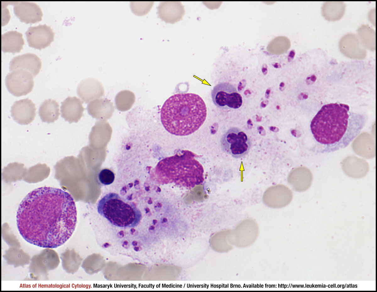 Visceral leishmaniasis - CELL - Atlas of Haematological Cytology