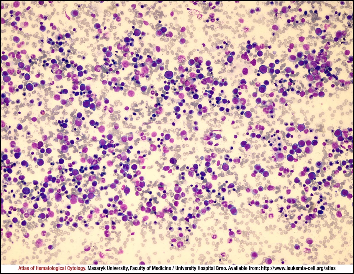 Vitamin B12 Deficiency Anemia Blood Smear at Jeffery Knight blog