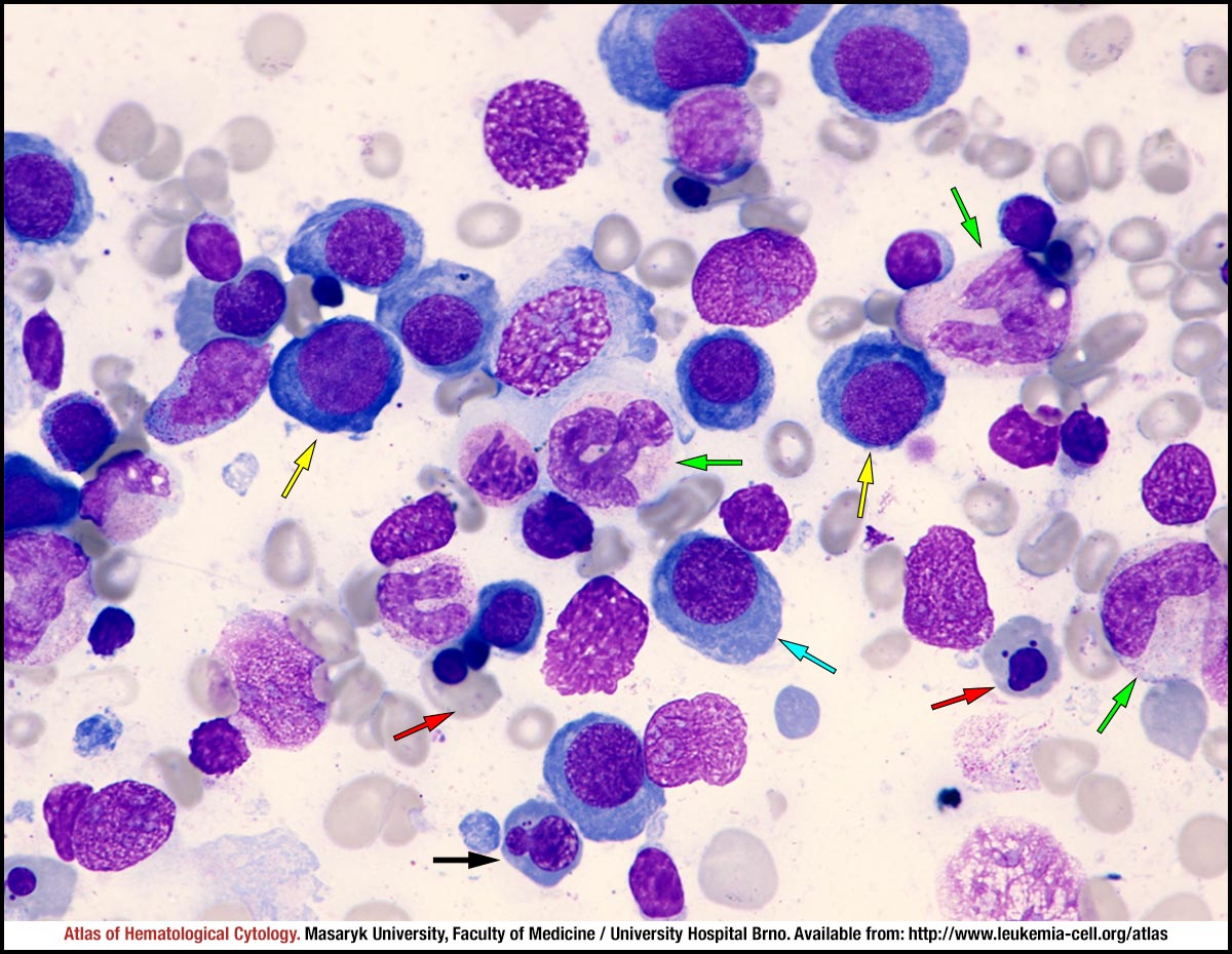 Vitamin B12 Deficiency Blood Smear at Victoria Brownlee blog
